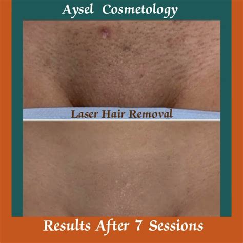 Laser Pubic Hair Removal Clean And Smooth Pubic Area Youtube