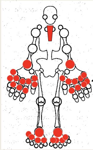 As Ra And Scleroderma Need To Know For Exam Template Flashcards Quizlet