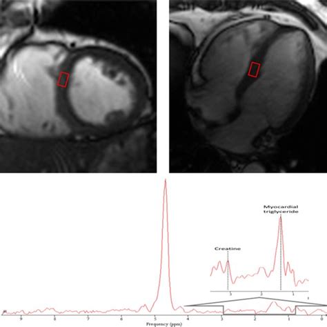 Measurement Of Myocardial Triglyceride Content By 1h Mrs Left