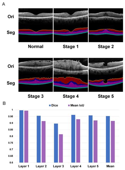 Ierm An Interpretable Deep Learning System To Classify Epiretinal