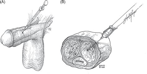 Figure 1 From Intracavernosal Injection For The Diagnosis Evaluation