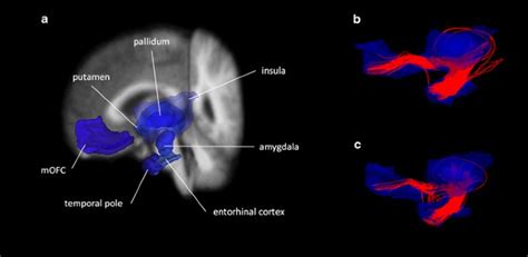 Connectomics Based Structural Network Alterations In Obsessive Compulsive Disorder