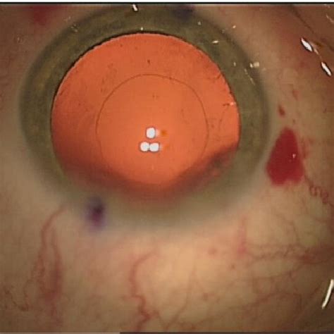 The Anterior Lens Capsule After Completion Of Anterior Lens Capsule
