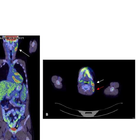 A Hypermetabolic Left Cervical Lymph Node 13cm In Diameter Suv Of