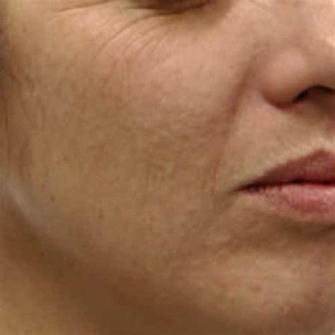 Quanta Discovery Pico Asclepion