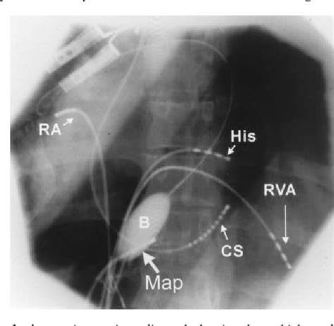 Structure Of Crista Terminalis Cordis Semantic Scholar