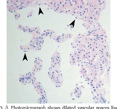 Figure 3 From A Case Report Of Multiple Cavernous Hemangiomas With Fluid Fluid Levels A Focus