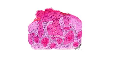 Pathology Of Squamous Cell Carcinoma Pathology Made Simple