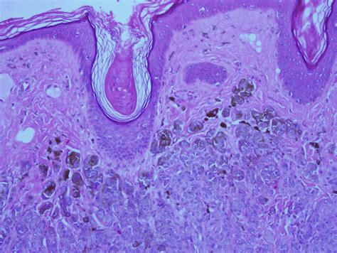 High Power View Shows Intact Dermo Epidermal Junction With Pigmented