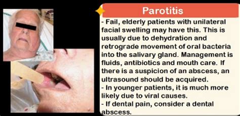 Parotitis