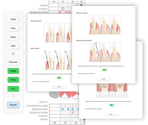Suportive Periodontal Therapy Spt Personalized Interval