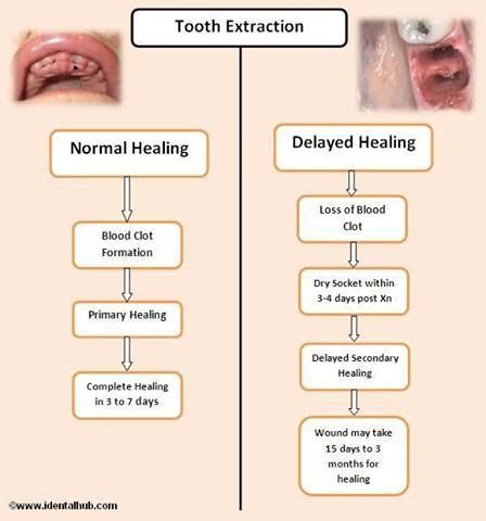 Tooth Extraction Aftercare Tooth Extraction Aftercare Tooth