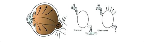 Diagram Of Glaucoma Pathogenesis The Reduced Outflow Or The
