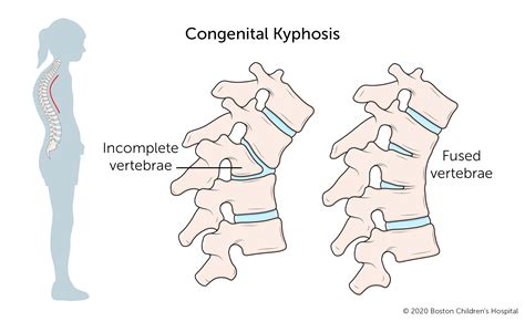 Thoracic Kyphosis Affects Spinal Loads And Trunk Muscle Force Iltxst