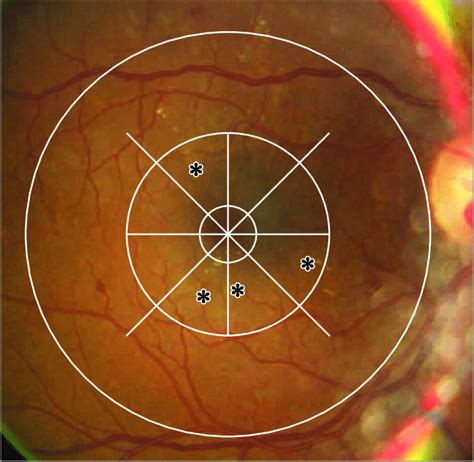 Macular Grid With 8 Radially Arranged Sectors Centered On The Fovea