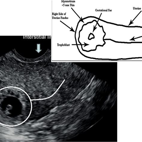 Pdf An Intrauterine Gestational Sac Surrounded By Thin Myometrium At
