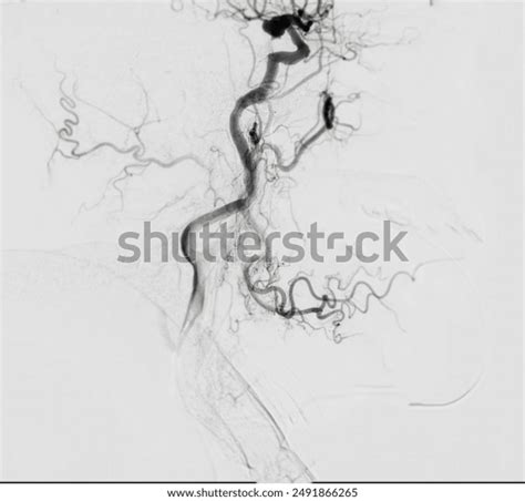Cerebral Angiography Specialized Procedure Visualize Arteries Stock Illustration