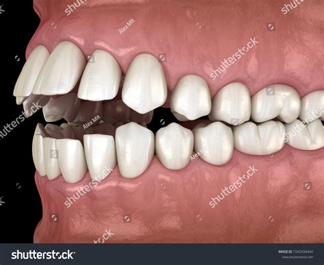 Edge To Edge Bite