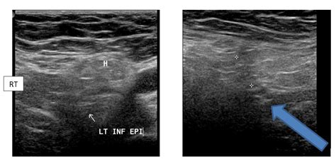 Inguinal Hernia