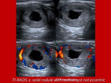 Tirads Thyroid Nodule Imaging Reporting And Data System Dr Ahmed E