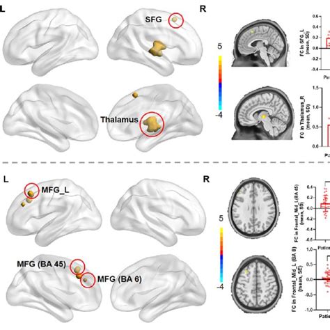 Brain Regions With Fc Alterations In Patients With Migraine A Relative Download Scientific