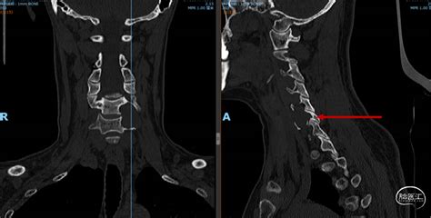 一例椎间孔神经鞘瘤的外科治疗策略 脑医汇