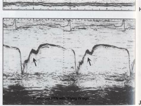 Ppt M Mode Echocardiography Powerpoint Presentation Free Download Id6591486