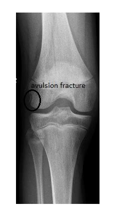 Medial Femoral Condyle Avulsion Fracture Image Distal Femur Fractures