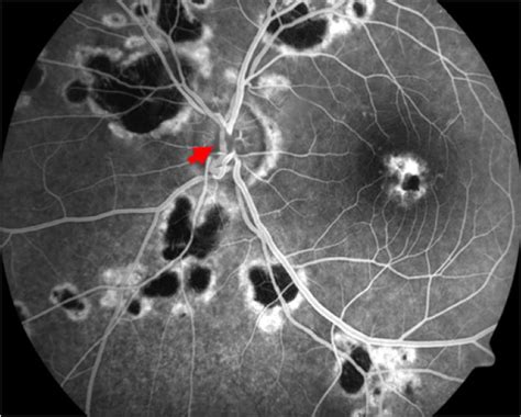 Left Optic Disk Aneurysm Involuted Red Arrow Download Scientific