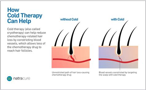 Natracure Chemotherapy Cooling Gel Ice Cap May Help