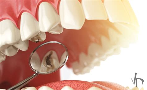 Pit And Fissure Caries Causes Diagnosis And Treatment Vdm Dental