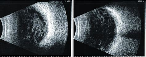 Bilateral Ocular Ultrasound Vitreous Opacification Download Scientific Diagram