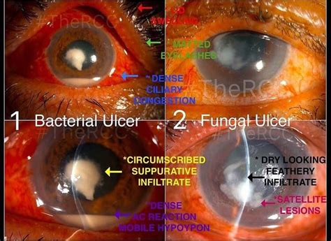 Rao Musaddaq Ali On Linkedin Bacterial Keratitis Vs Fungal Keratitis Photo Credit