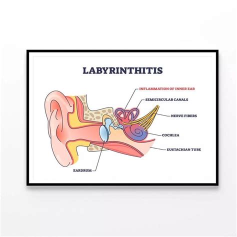 Labyrinthitis As Inner Ear Infection Diagram Print 100 Australian Made