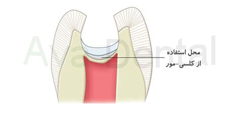 دایکال نوری مروابن Calci Mor کلسی مور Morvabon آوادنتال