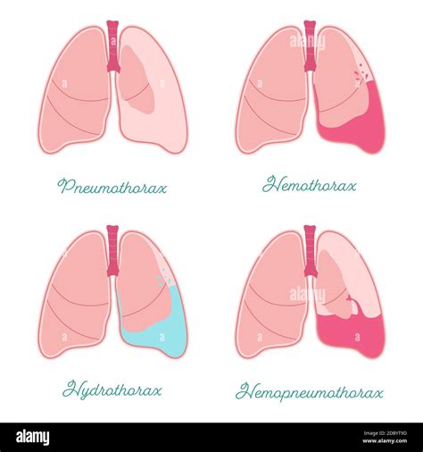Pneumothorax Definition Types And Classification Preview 43 Off