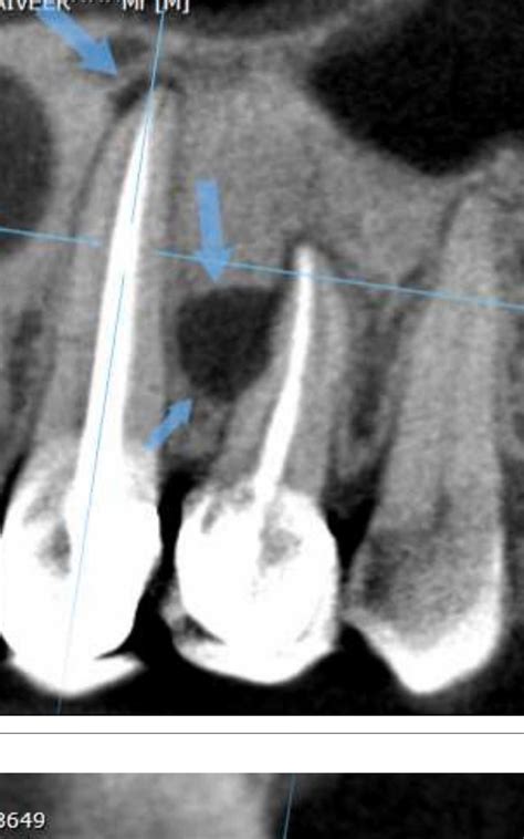 Case Of The Day Cyst Enucleation Dental Brasstacks Facebook