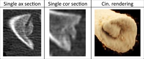 Partly Fused Single Epiphysis Embedded In Metaphyseal Cavity Forming