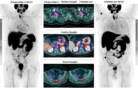 Intra Individual Comparison Of Physiologic [68ga]ga Psma 11 And [18f