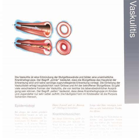 Vaskulitis Paediatrie Praxis And Info