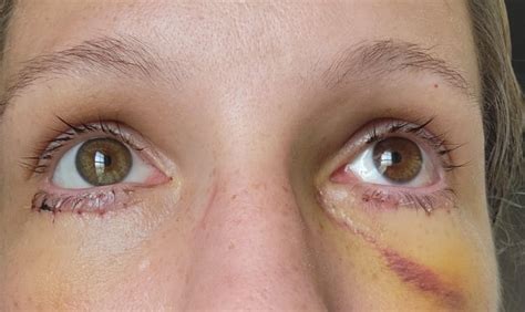 Lower Bleph Progression Rplasticsurgery