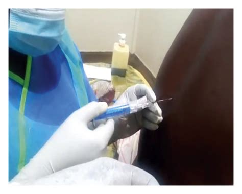 A Wet Tap During Epidural Placement Download Scientific Diagram