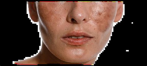 What Is Discoloration