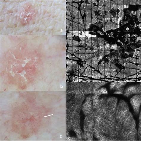 Microinvasive Squamous Cell Carcinoma A Clinical Presentation Scaly