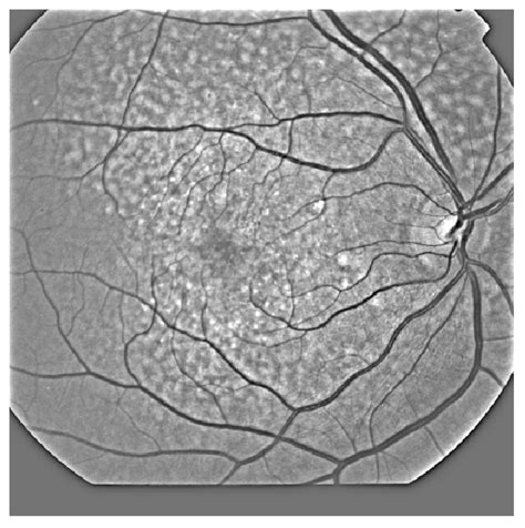 Image Obtained By Homomorphic Filtering Of Image In Fig1 Download