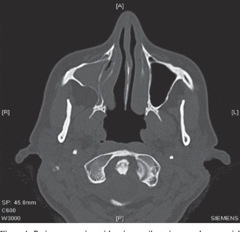 Table 1 From Spontaneous Silent Sinus Syndrome Imploding Antrum