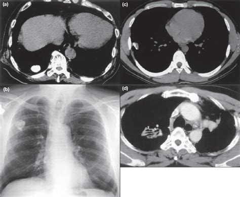 Computed Tomograms And X Rays Of A Solitary Pulmonary Nodule A A Download Scientific Diagram