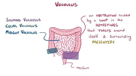 Volvulus Video Anatomy Definition And Function Osmosis