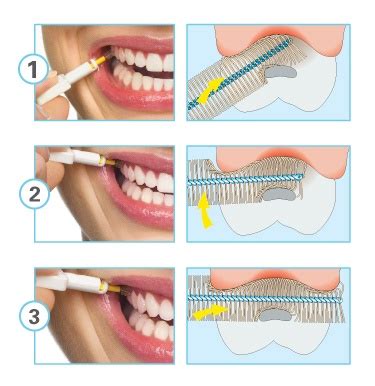 How To Use Interdental Brushes Dentalsreview