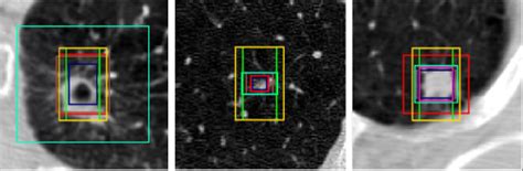 Figure From Lung Nodules Identification In CT Scans Using Multiple Instance Learning